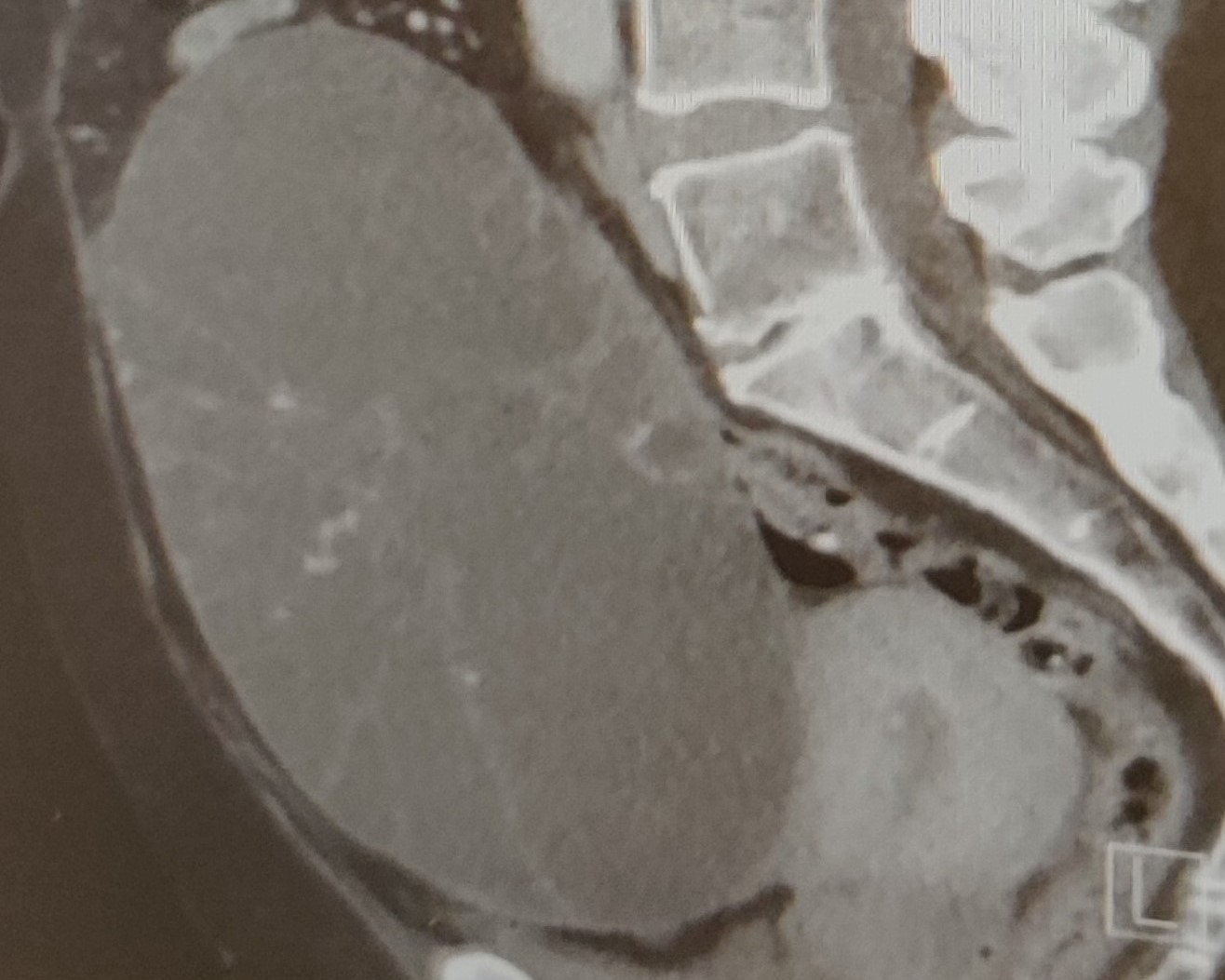 Postmenopauzaal: Grote multicysteuze cyste 15 cm, borderline tumor of ...