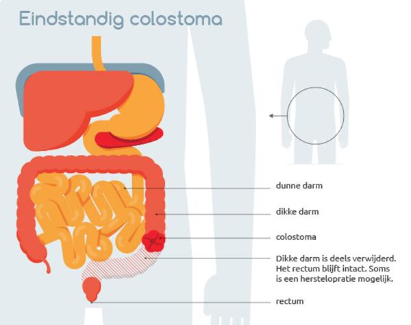 Aanleg colostoma