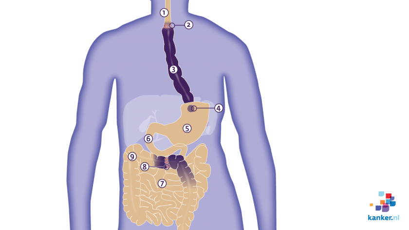 Operatie bij slokdarmkanker / oesofaguscarcinoom / slokdarmcarcinoom