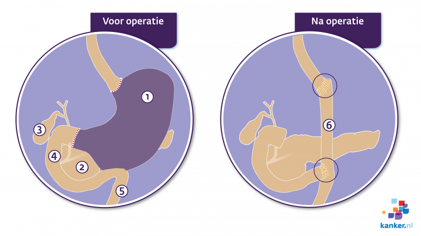 Operatie bij maagkanker / adenocarcinoom / maagcarcinoom