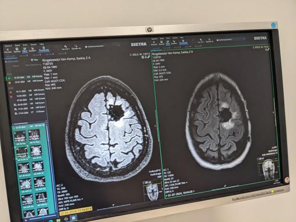 Deel 5 :Scanxiety, het verhaal van de mri waardoor de behandeling begon ...