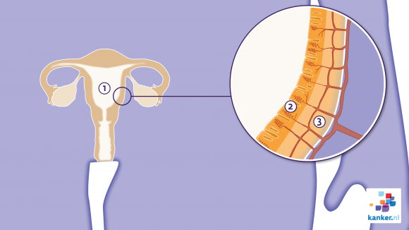Baarmoedersarcoom? Lees betrouwbare info - Kanker.nl