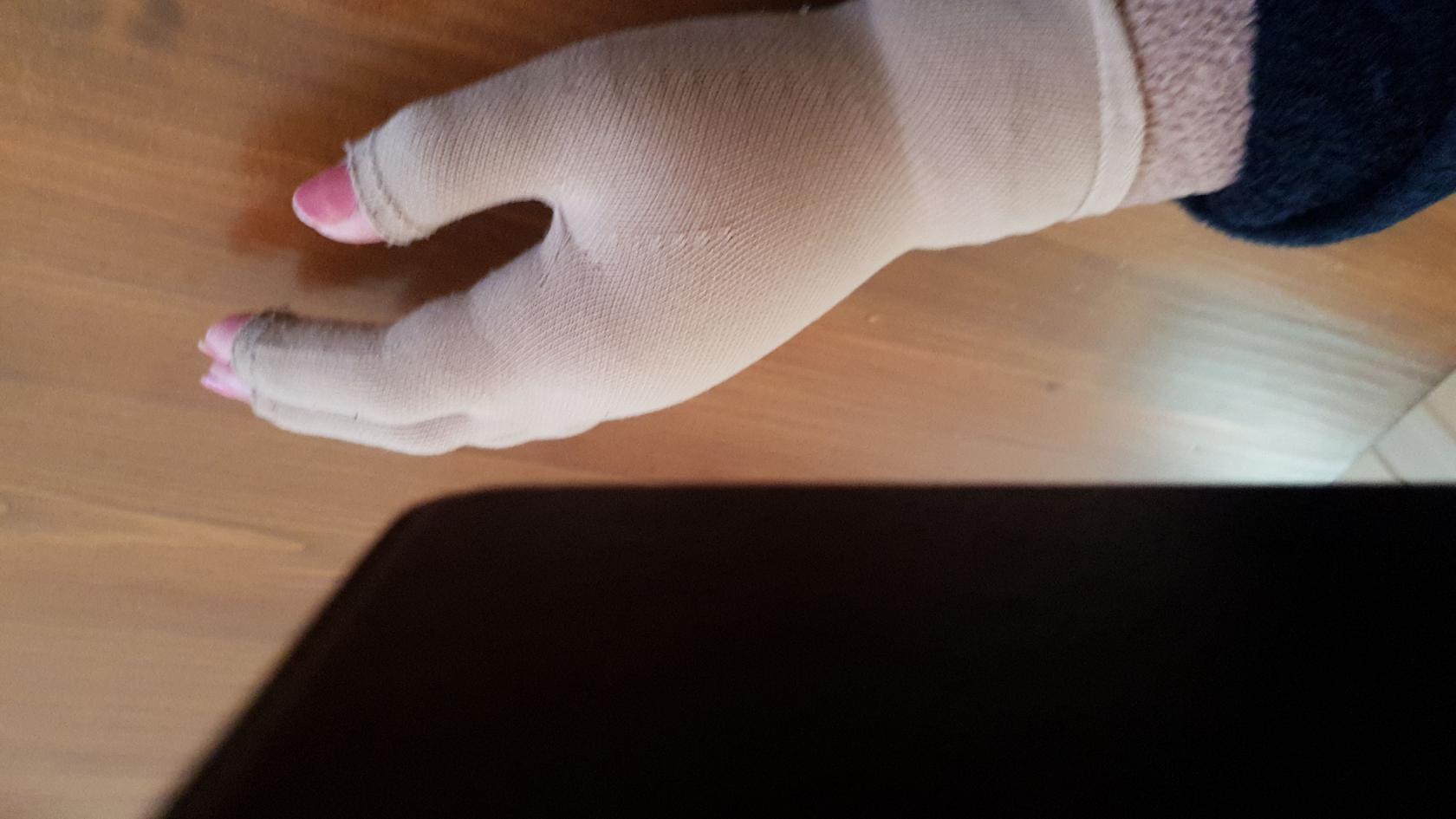 Oedeem arm | Kanker.nl