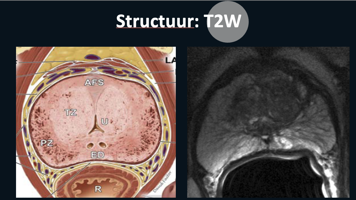 Waaruit bestaat prostaat MRI? | Kanker.nl
