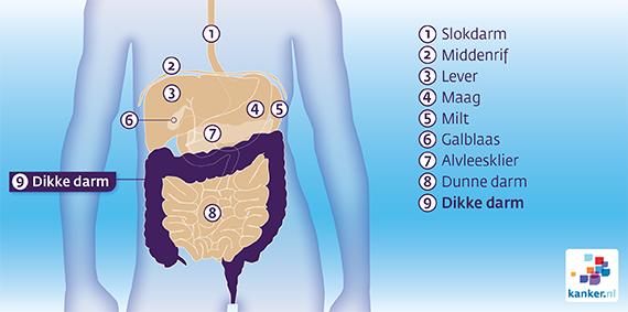 Polyposis? Lees betrouwbare info - Kanker.nl