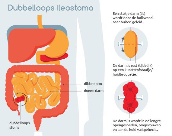 Aanleg ileostoma