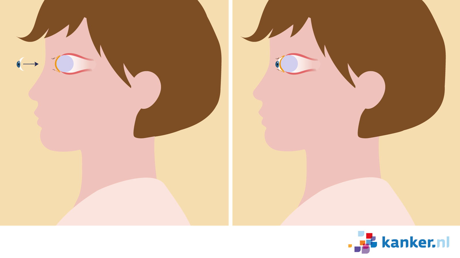 Verwijdering van het oog bij oogmelanoom | Kanker.nl