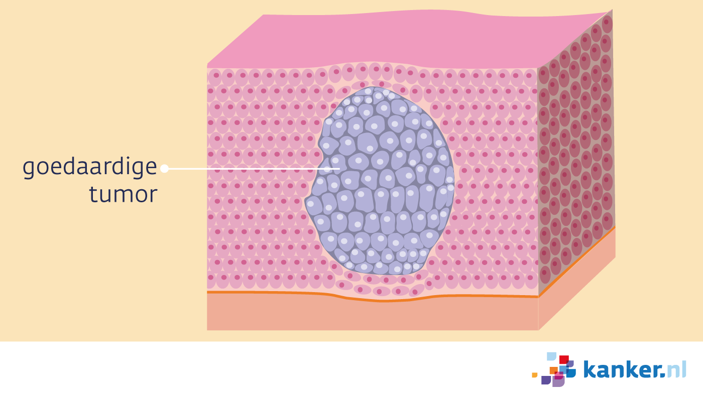 Goedaardige en kwaadaardige tumoren