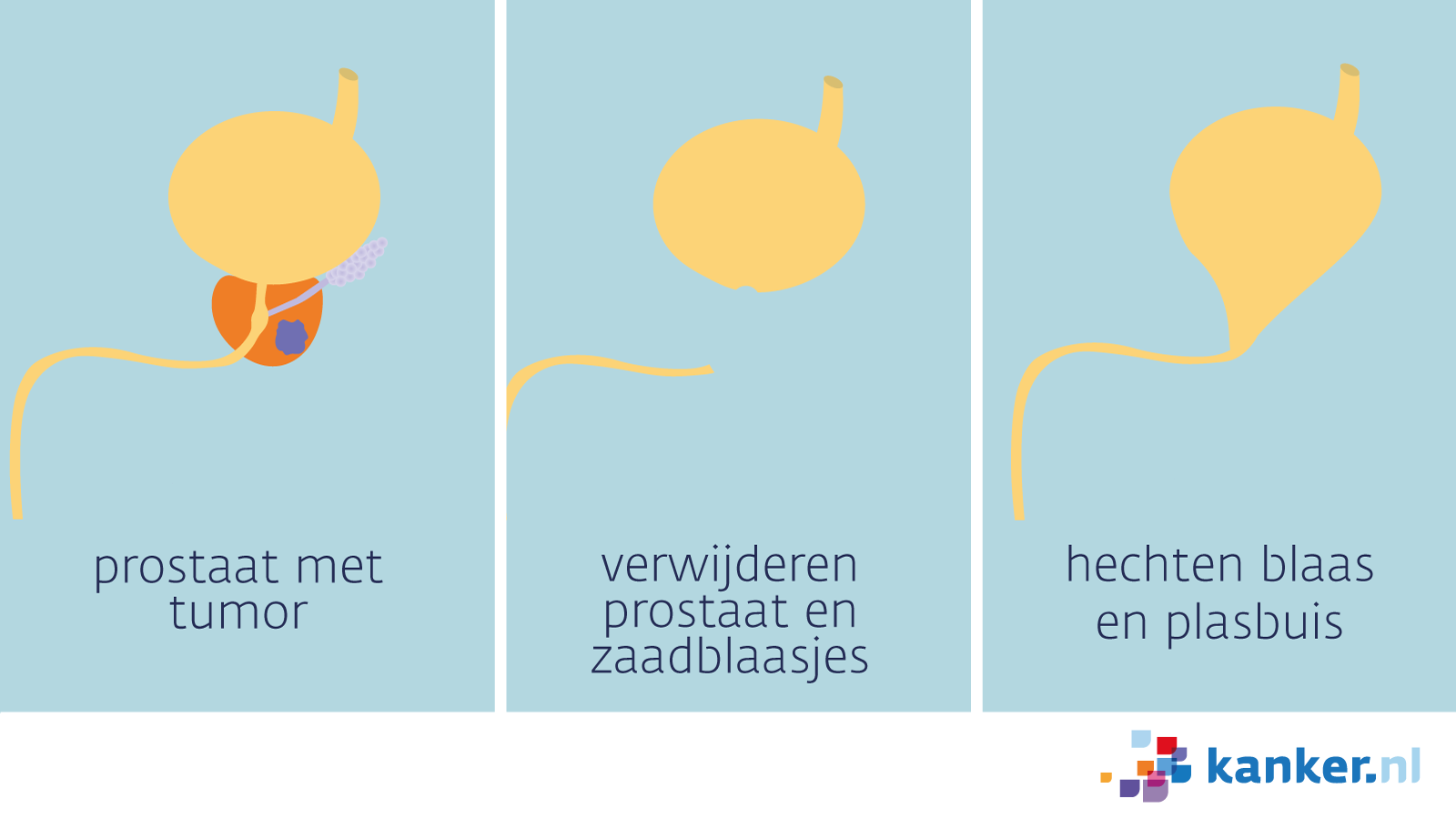 Operatie bij prostaatkanker (radicale prostatectomie) | Kanker.nl