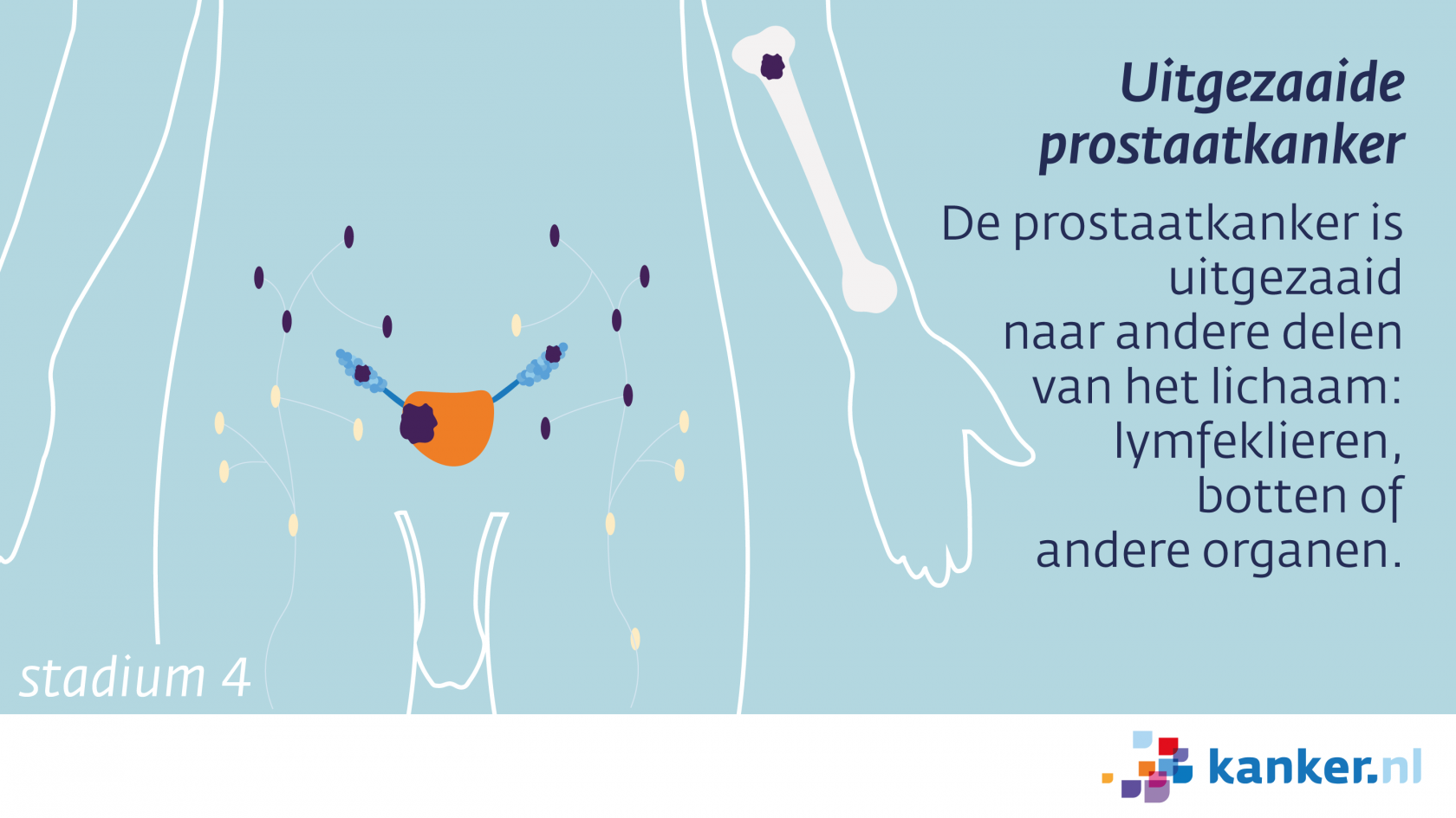 Het stadium van prostaatkanker | Kanker.nl