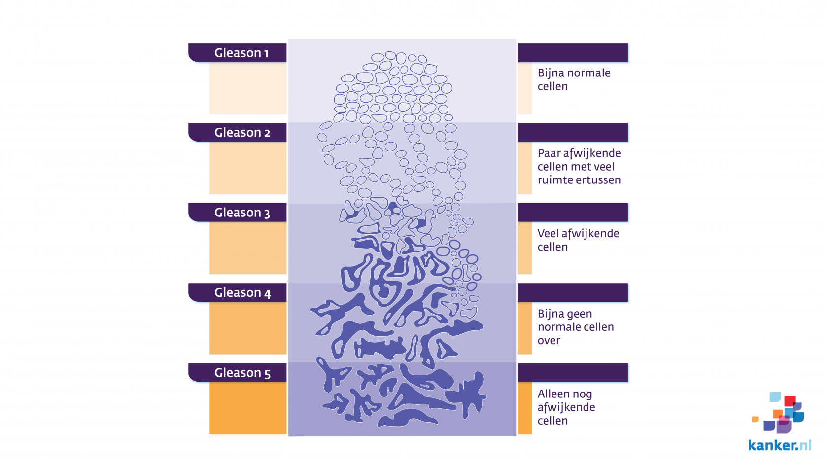 Gleason-score prostaatkanker - kanker.nl