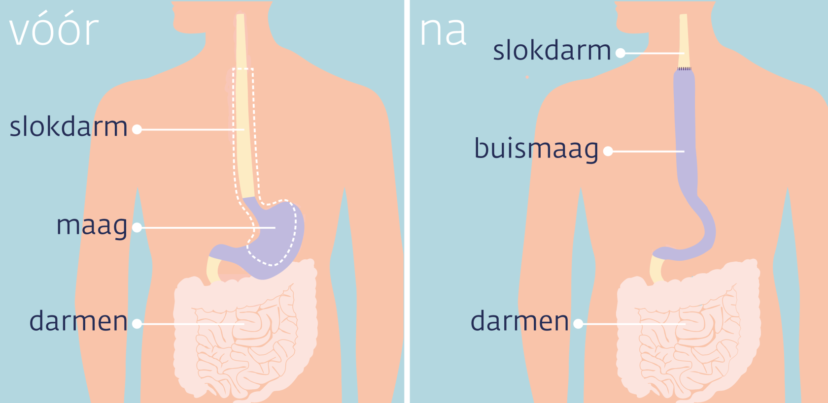 Maag Anatomie Leven Met Een Buismaag Na Slokdarmkanker | Kanker.nl