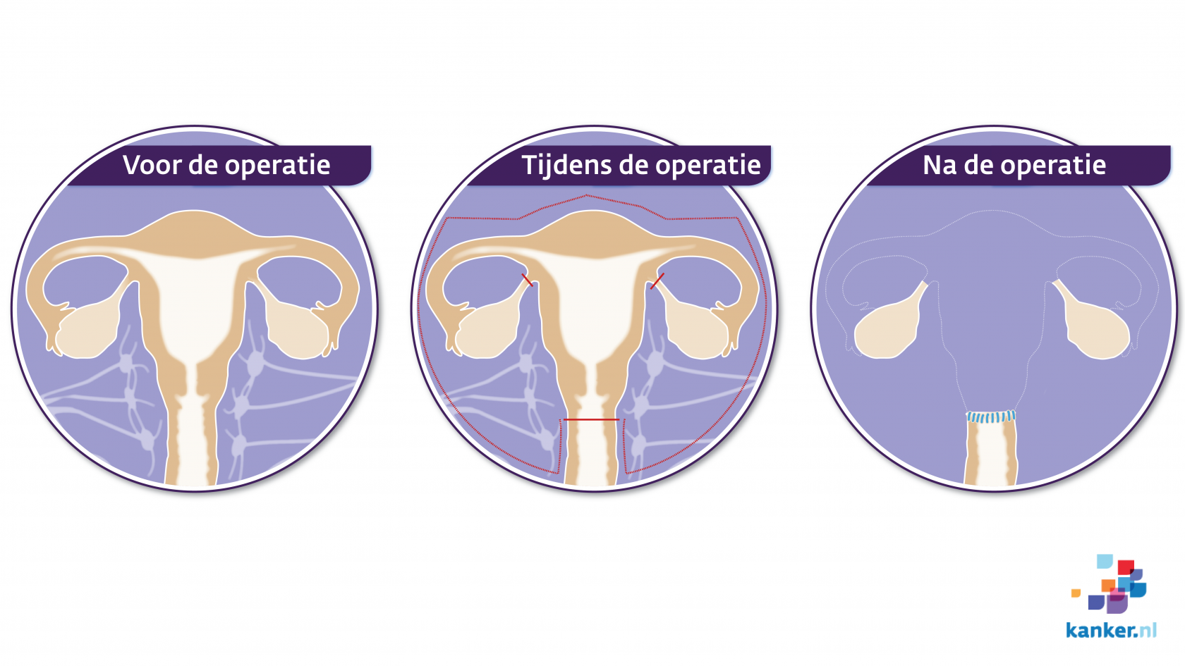 Operatie bij baarmoederhalskanker | Kanker.nl