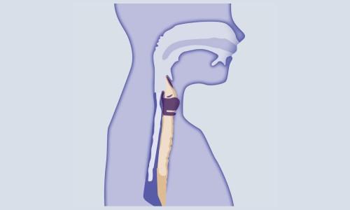 Klachten | Kanker.nl