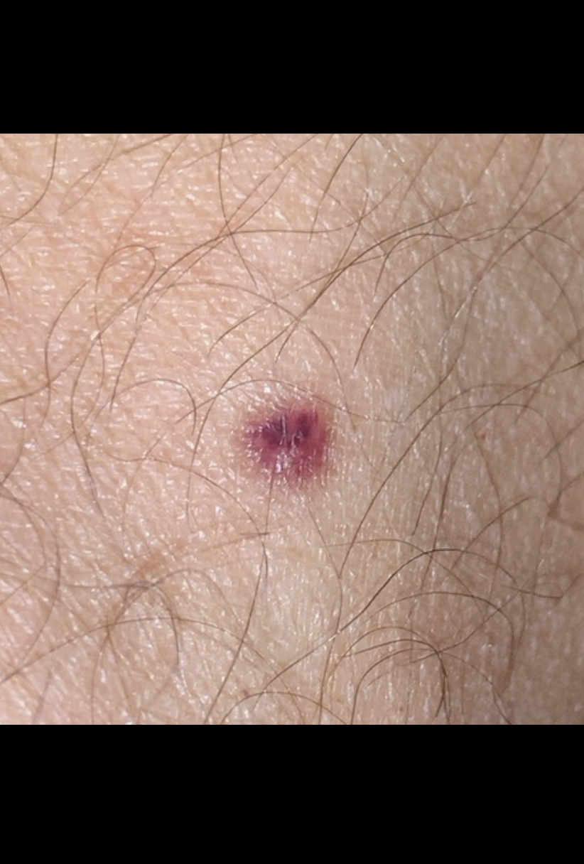 Melanoom | Kanker.nl